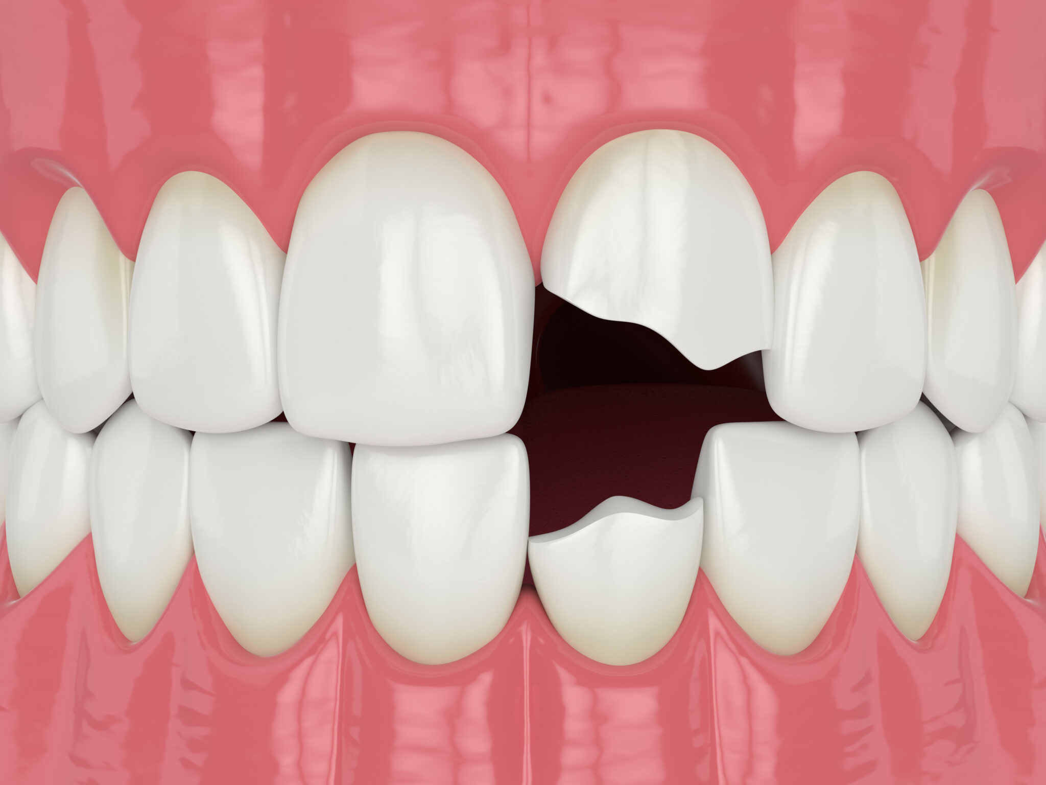 Repairing Smiles With Chipped Teeth | Prairie Village, KS