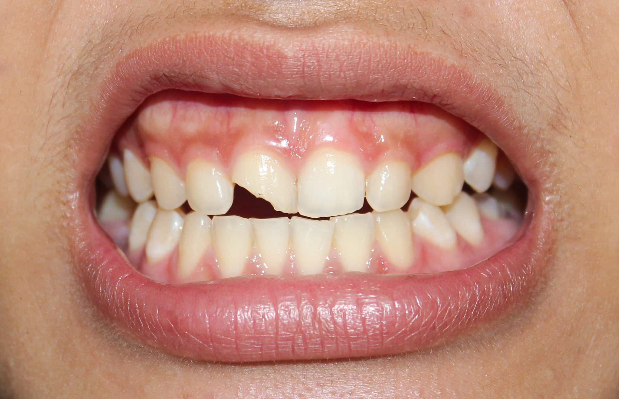 What Happens When You Damage A Tooth? | Prairie Village, KS